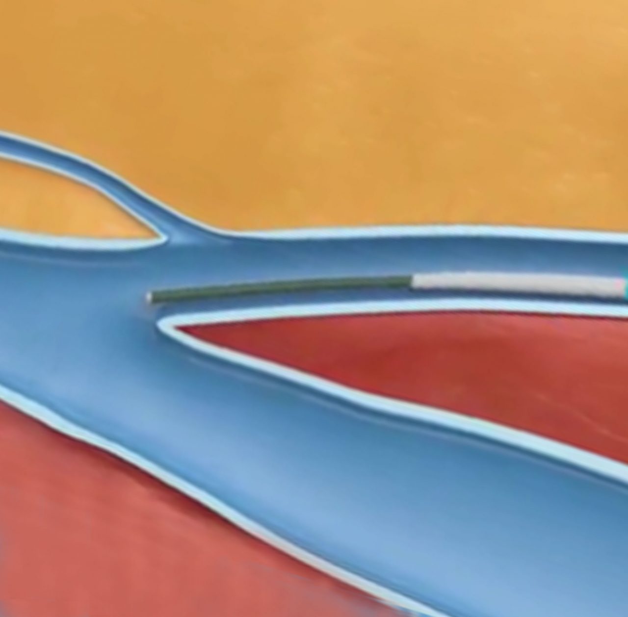 Vein treatments in Hawaii on the Big Island