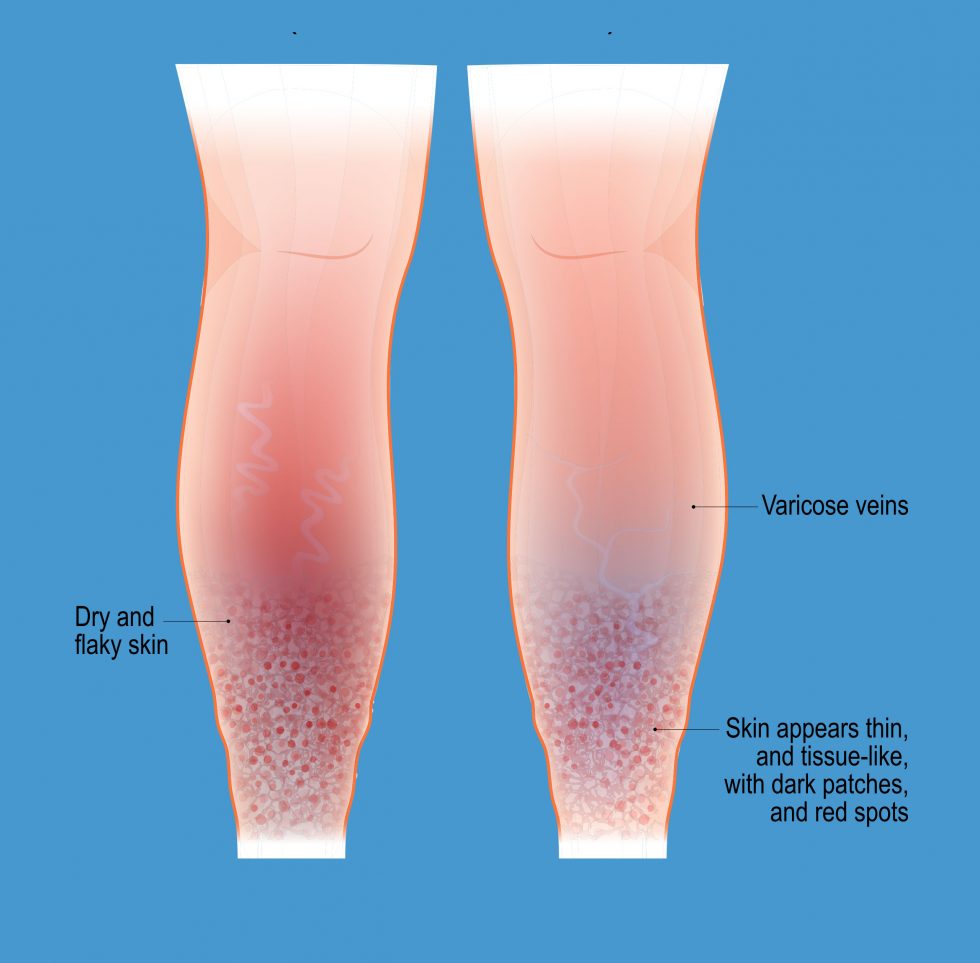 Vein Doctor in Hawaii | Diagnosing and Treating Vein Disease